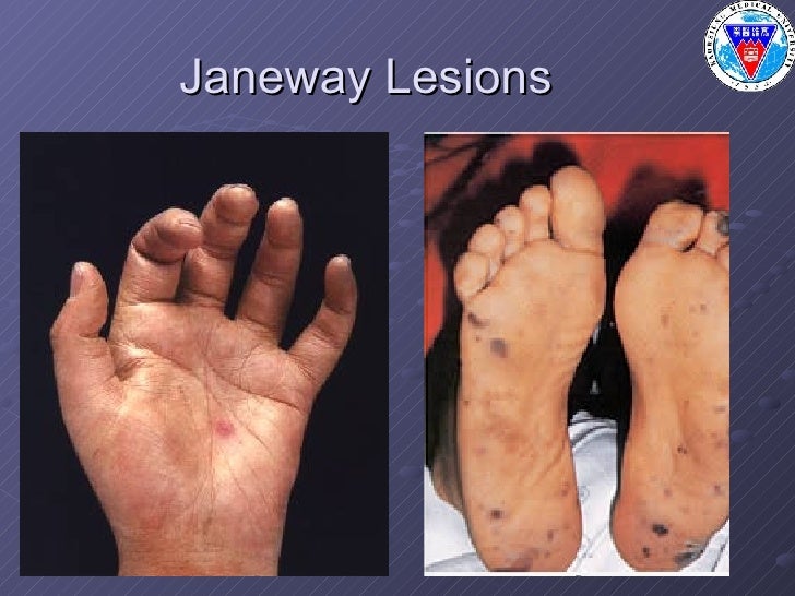 Janeway Lesions Feet