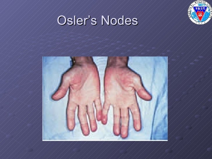 Infective endocarditis