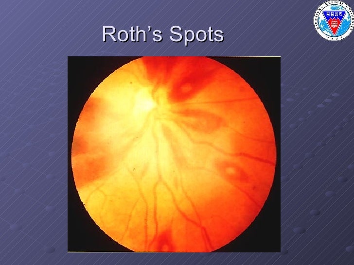 Infective endocarditis
