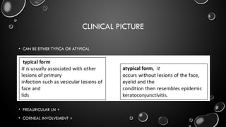 Infective Conjunctivitis acute follicular conjunctivitis associated ...