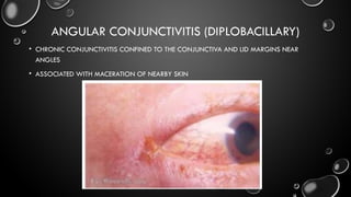 Infective Conjunctivitis acute follicular conjunctivitis associated ...