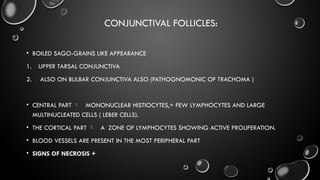 Infective Conjunctivitis acute follicular conjunctivitis associated ...