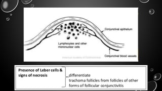 Infective Conjunctivitis acute follicular conjunctivitis associated ...
