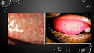 Infective Conjunctivitis acute follicular conjunctivitis associated ...