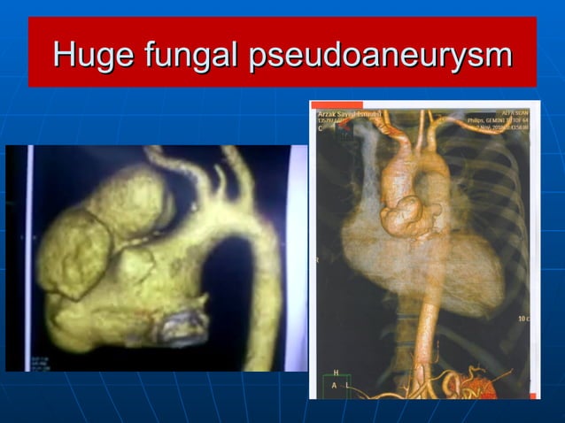 Infective endo. for 18th eschs marriot | PPT | Heart and Cardiovascular ...