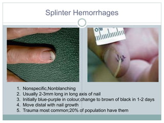 Splinter Haemorrhage Infective Endocarditis