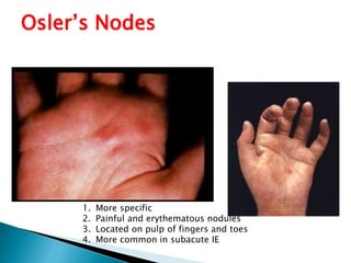Infective endocarditis | PPTX