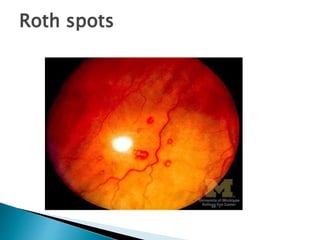 Infective endocarditis | PPTX