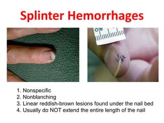 Infective endocarditis | PPT | Free Download