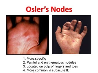 Infective endocarditis | PPT