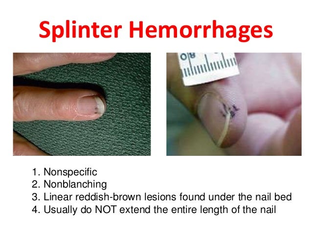 Infective endocarditis