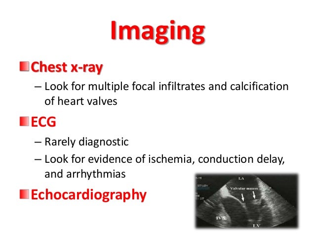 Endocarditis Ecg
