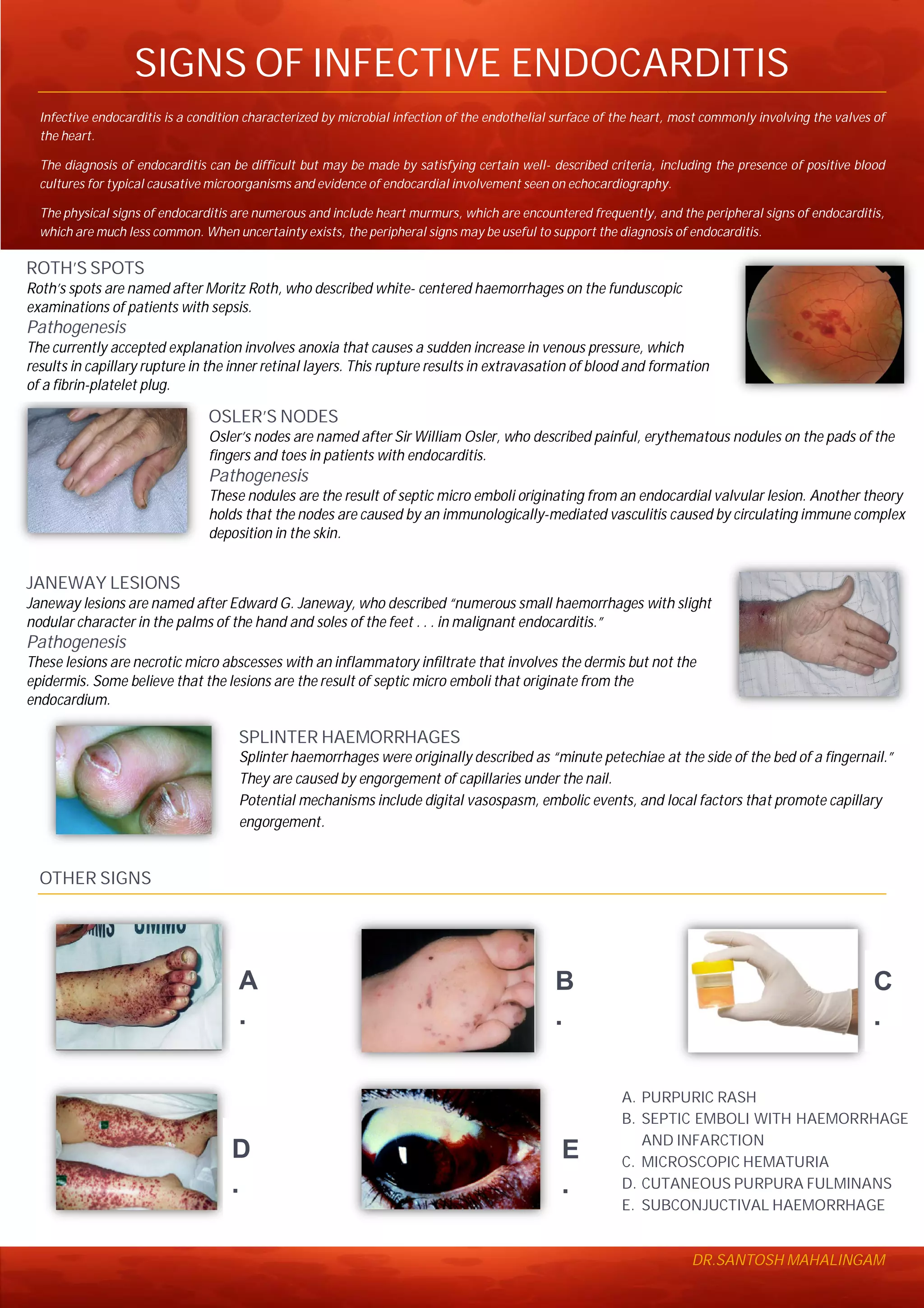 Infective endocarditis | PDF