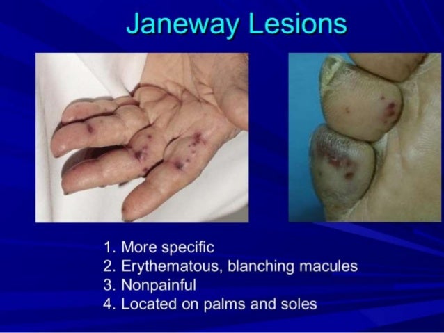 Janeway Lesions Feet