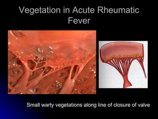 Infective endocarditis | PPT