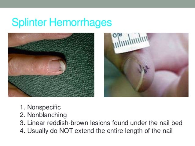 Infective endocarditis