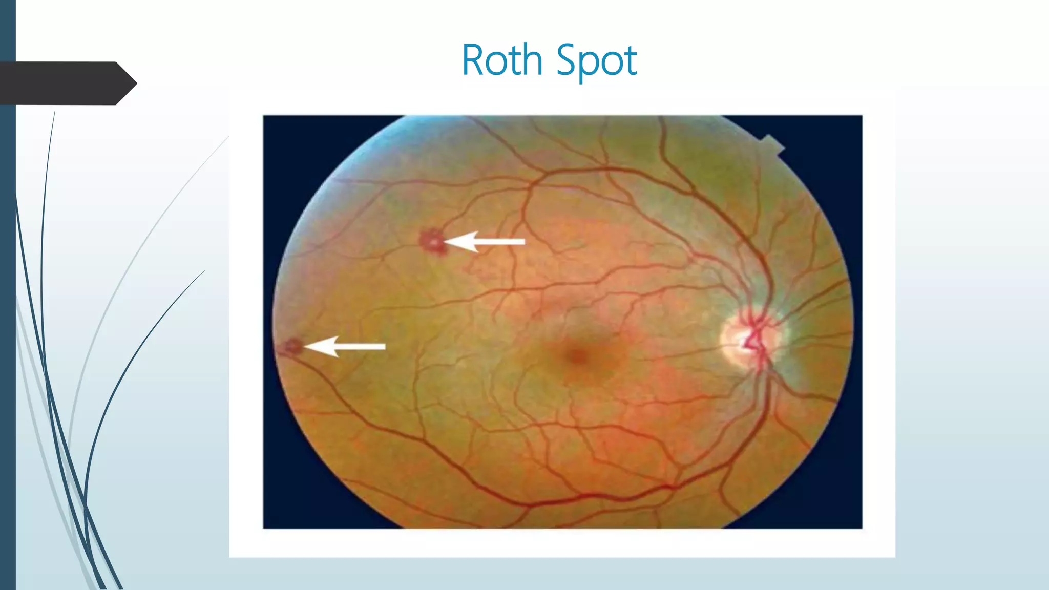Infective endocarditis | PPTX
