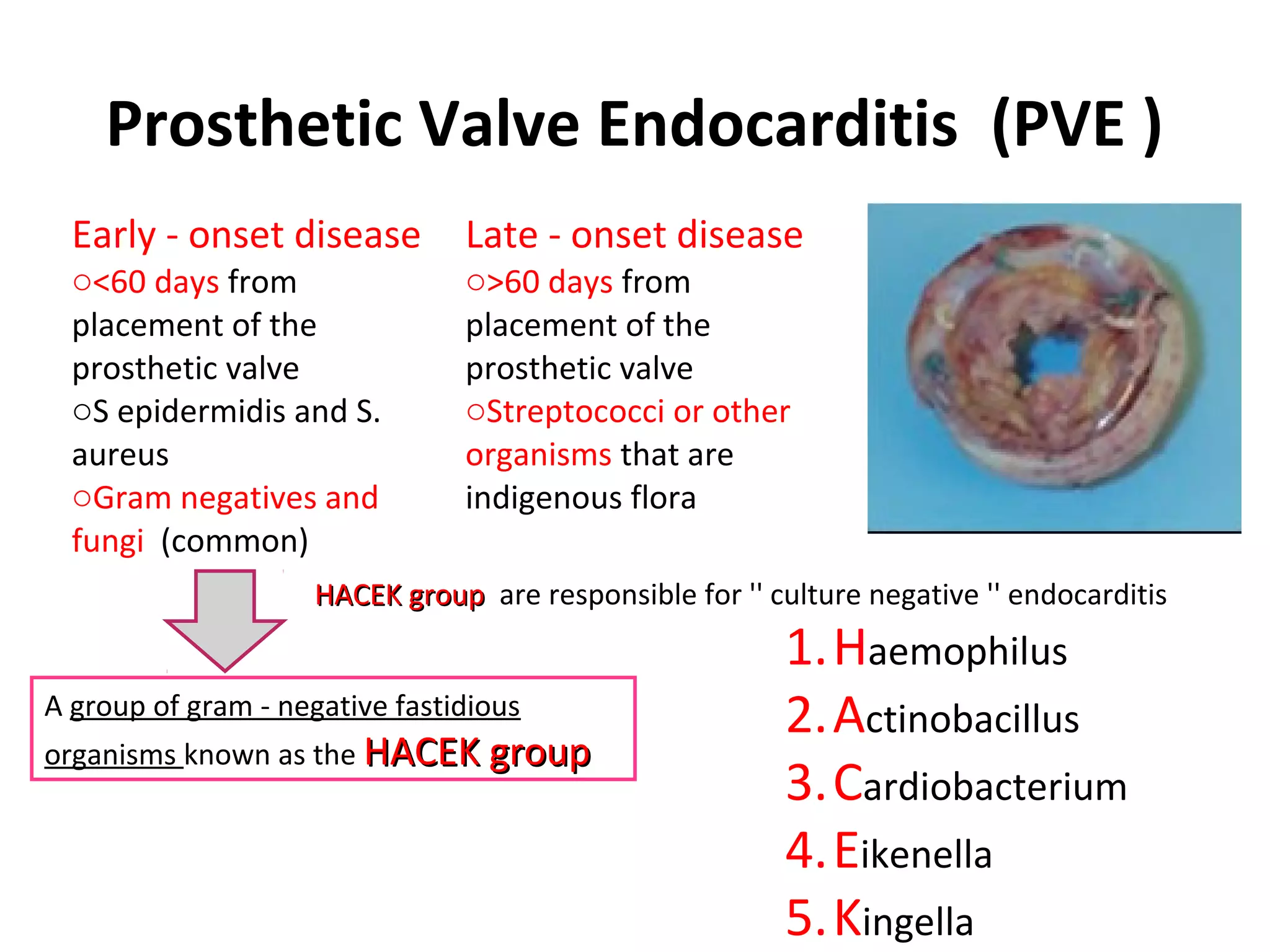 Infective endocarditis | PPT