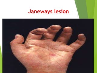 infectiveendocarditis-180301061044 (1).pdf