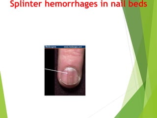 infectiveendocarditis-180301061044 (1).pdf