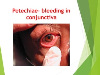 infectiveendocarditis-180301061044 (1).pdf