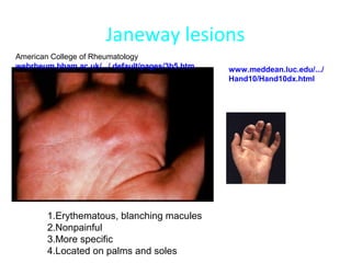 Infective endocarditis | PPT