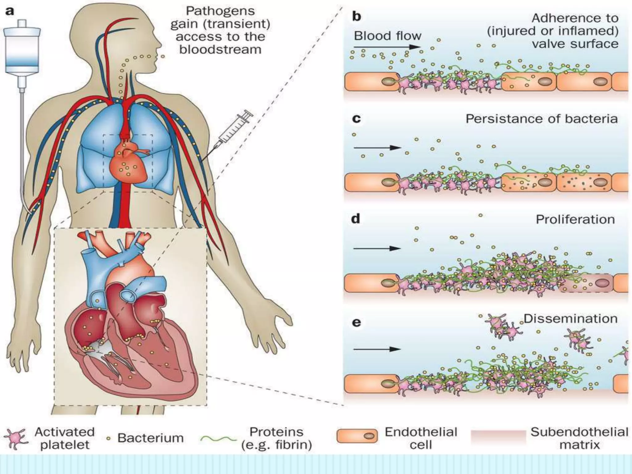 Infective endocarditis | PPTX | Heart and Cardiovascular Diseases ...