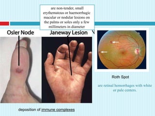 Infective endocarditis | PPT