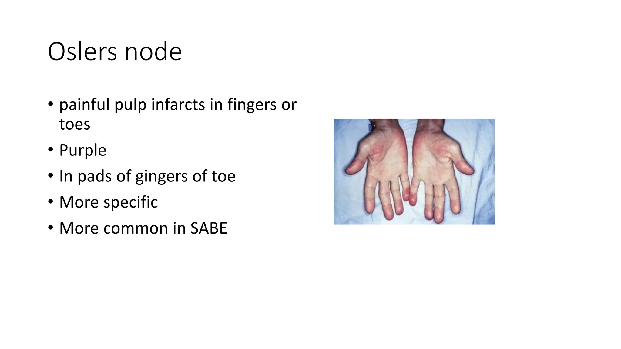 Infective endocarditis revision notes | PDF