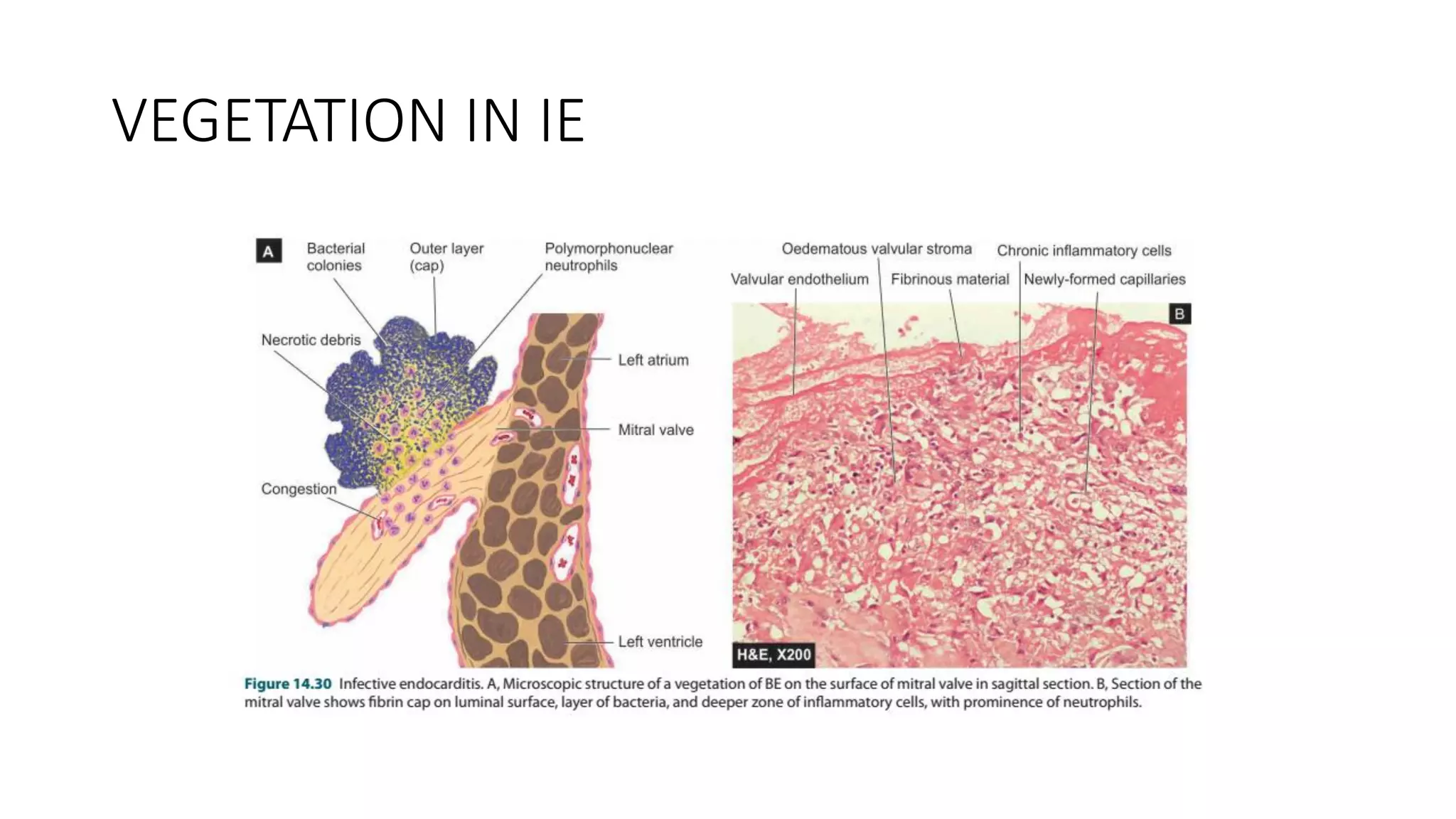 Infective endocarditis revision notes | PDF