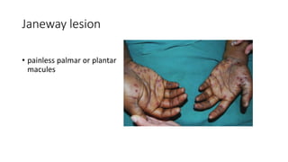 Infective endocarditis revision notes | PDF