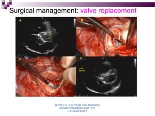 Infective endocarditis | PPT
