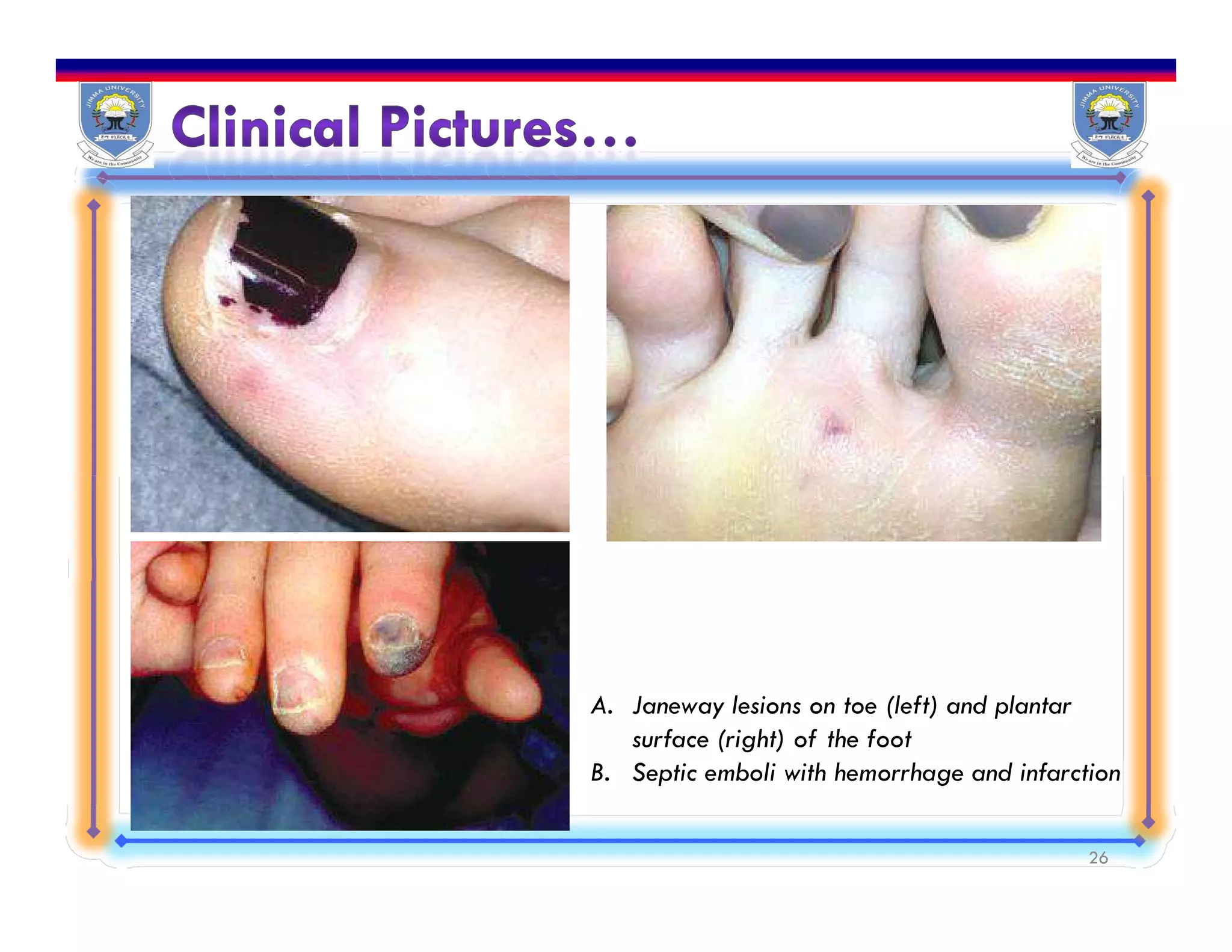 Pharmacotherapy of Infective endocarditis | PDF