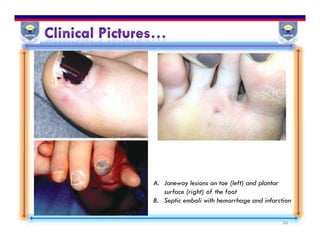 Pharmacotherapy of Infective endocarditis | PDF
