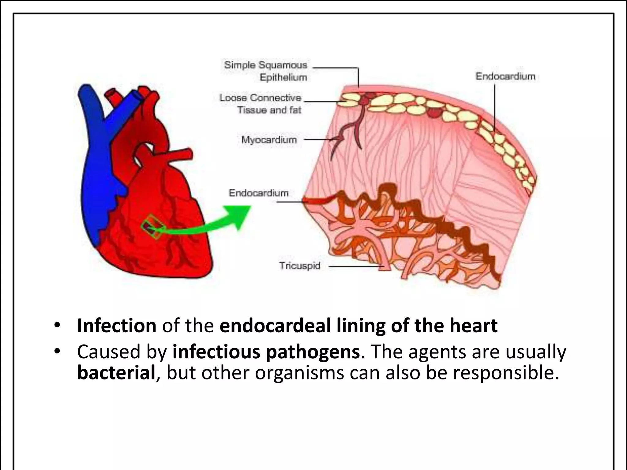 Infective Endocarditis Paediatrics | PPTX