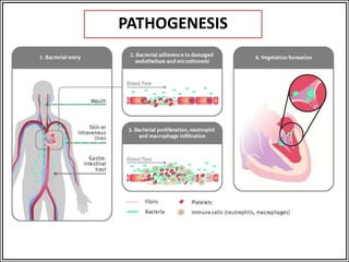 Infective Endocarditis Paediatrics | PPTX