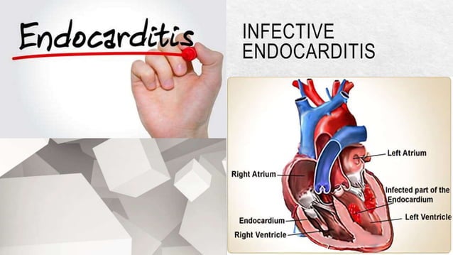 Infective endocarditis | PPT