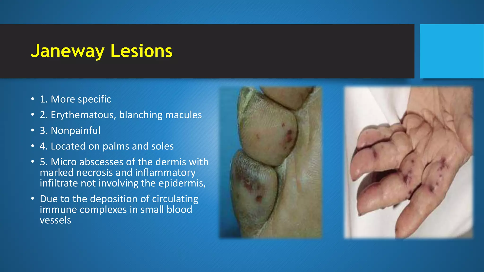 Infective endocarditis | PPTX