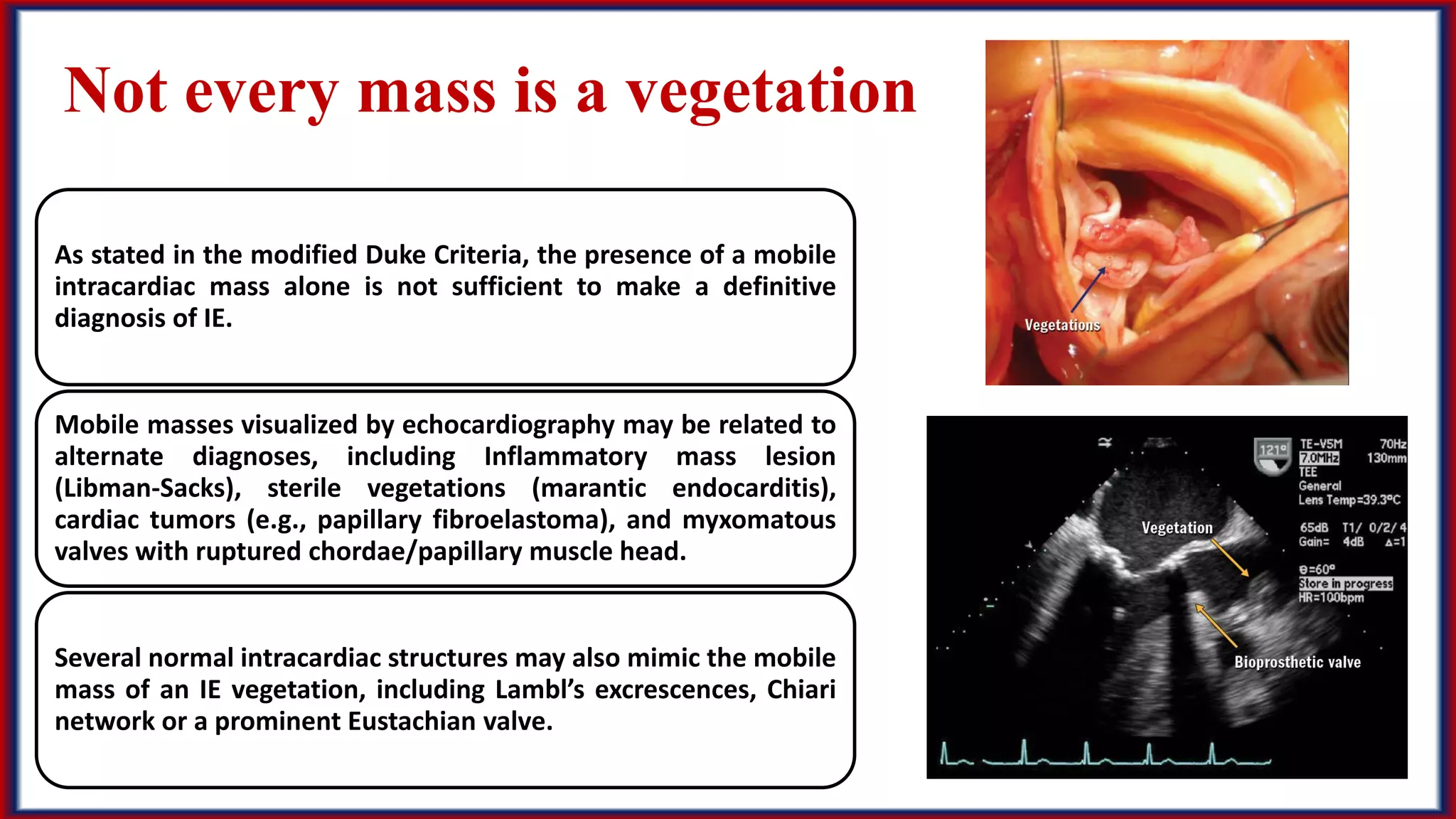Infective Endocarditis | PPT