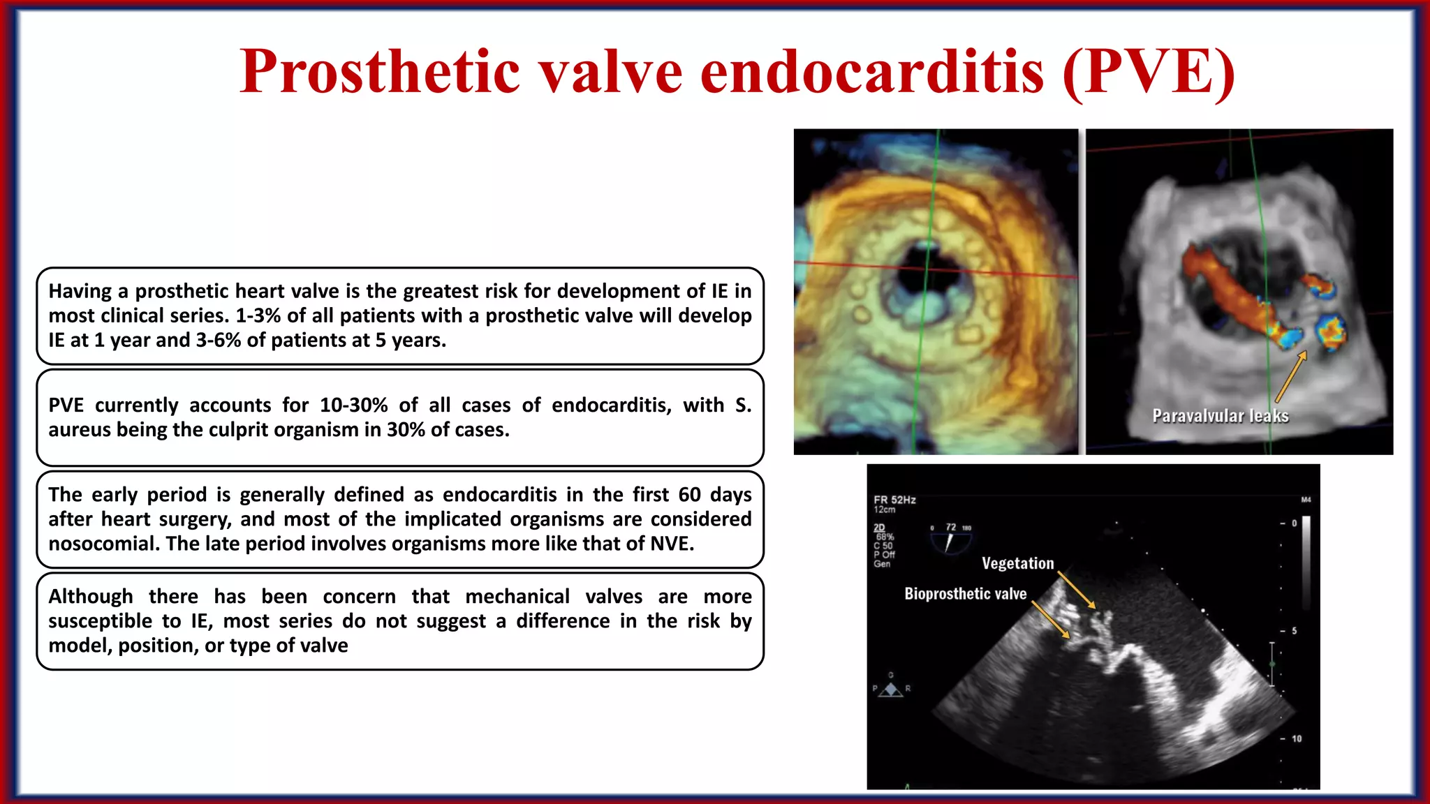 Infective Endocarditis | PPT