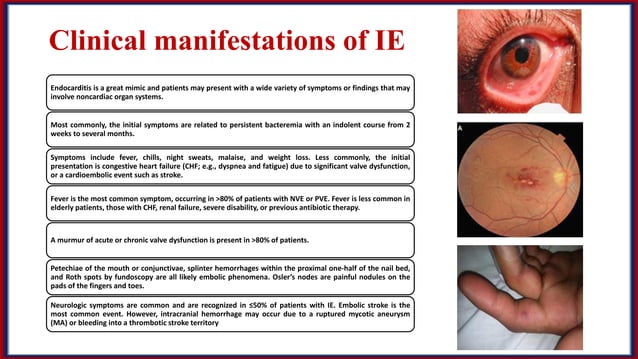 Infective Endocarditis | PPT