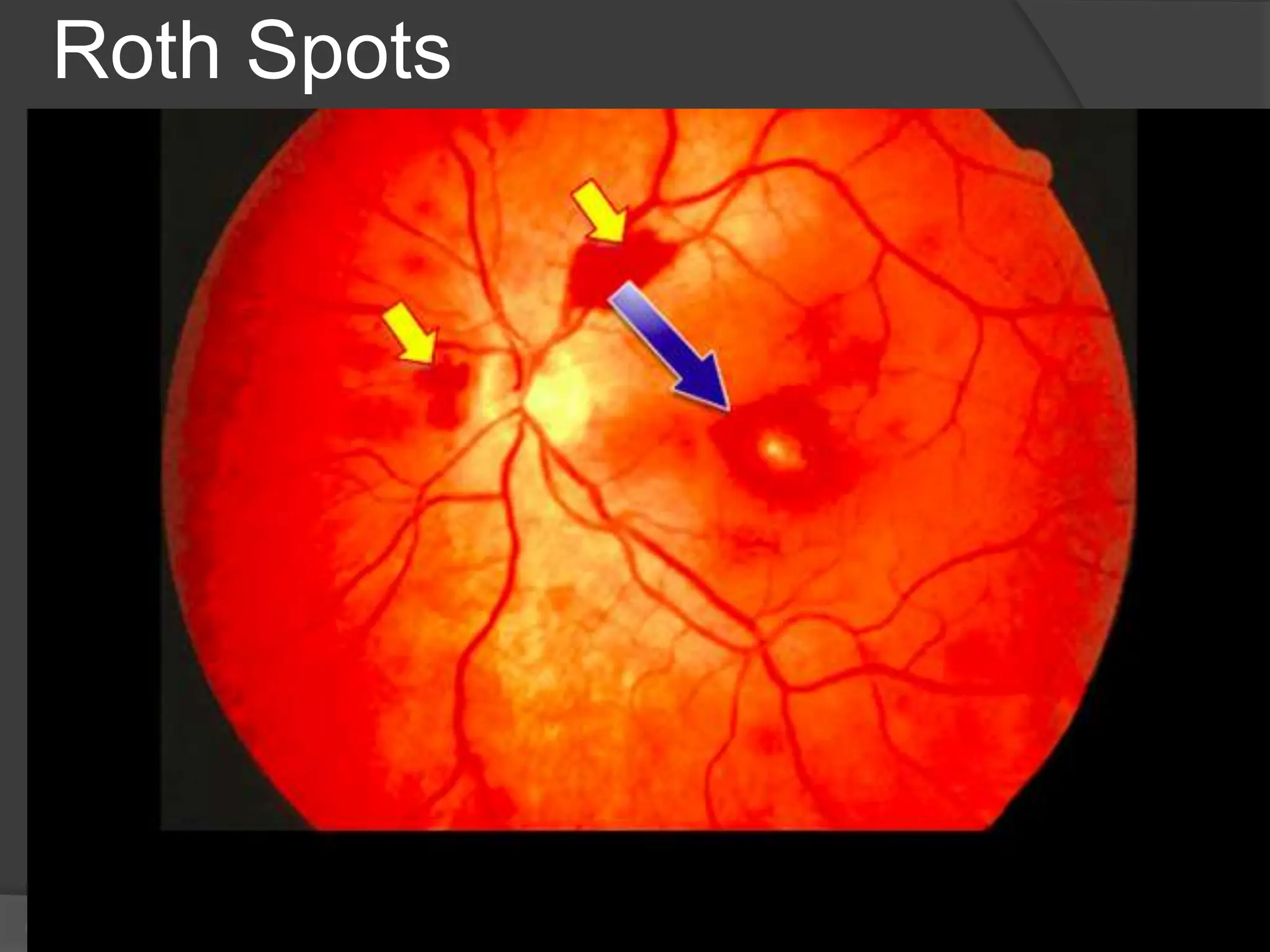 Infective Endocarditis.ppt