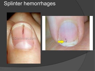 Infective Endocarditis.ppt