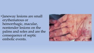 INFECTIVE ENDOCARDITIS.pptx