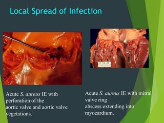 infective endocarditis a complete presentation.ppt