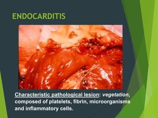 infective endocarditis a complete presentation.ppt