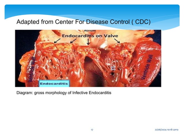 Infective Endocarditis by medical students pptx | PPT
