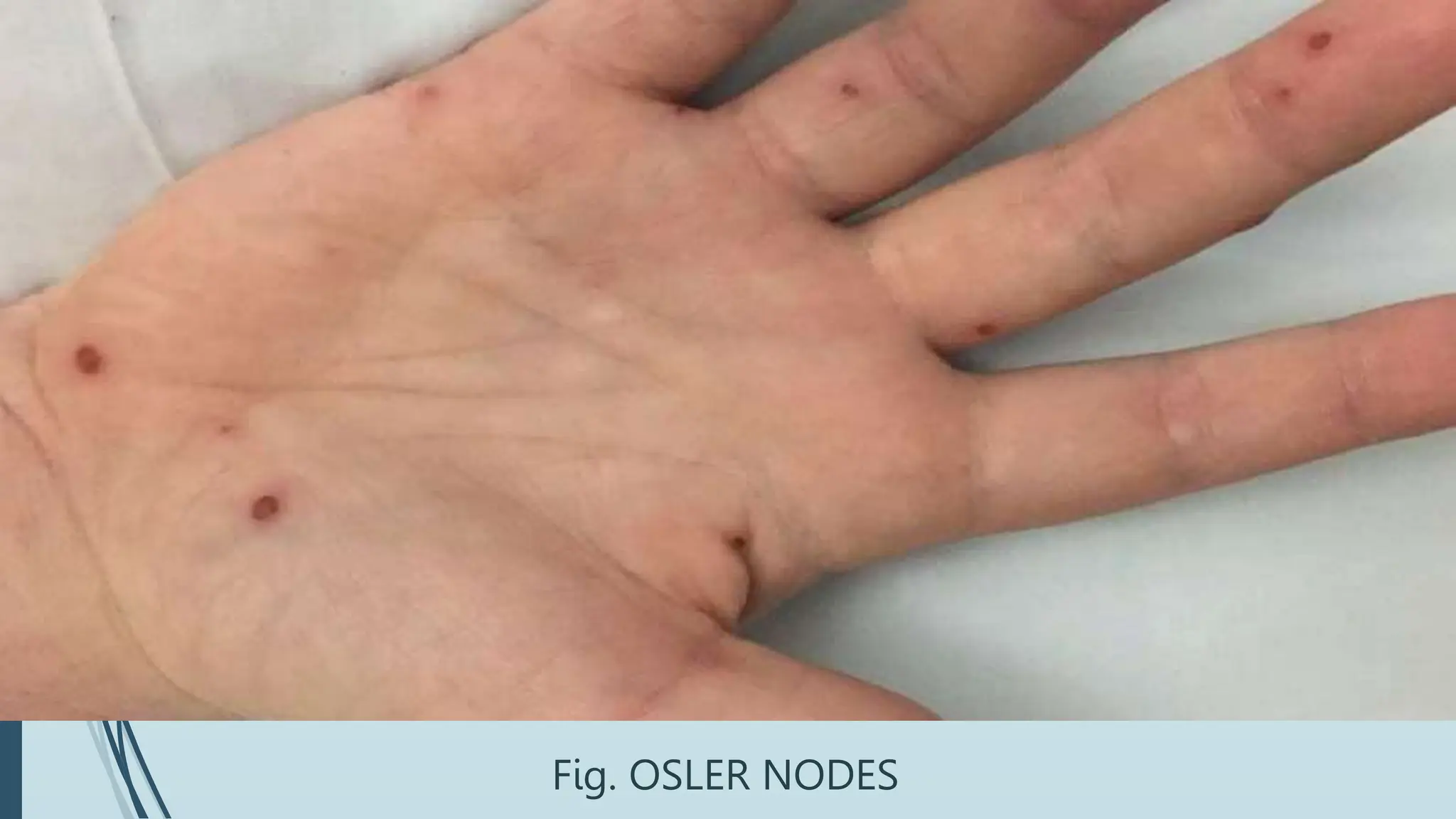 INFECTIVE ENDOCARDITIS.pptx by Dr. Humna | PPTX | Heart and ...