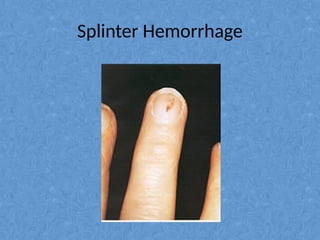 Infective Endocarditis is mostly bacterial | PPT