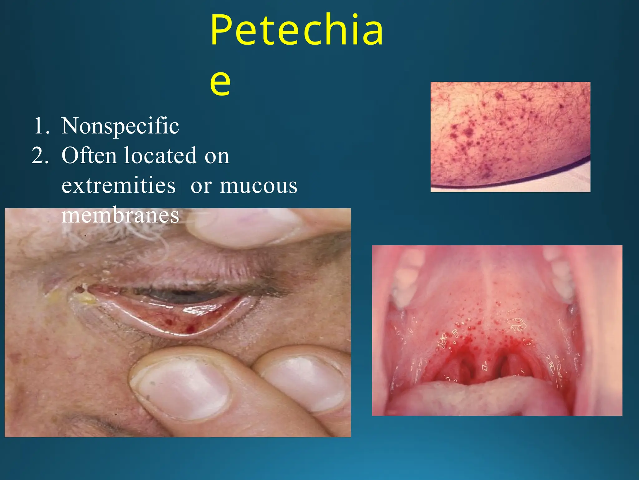 Infective endocarditis Endocrine Causes – Primary Aldosteronism ...
